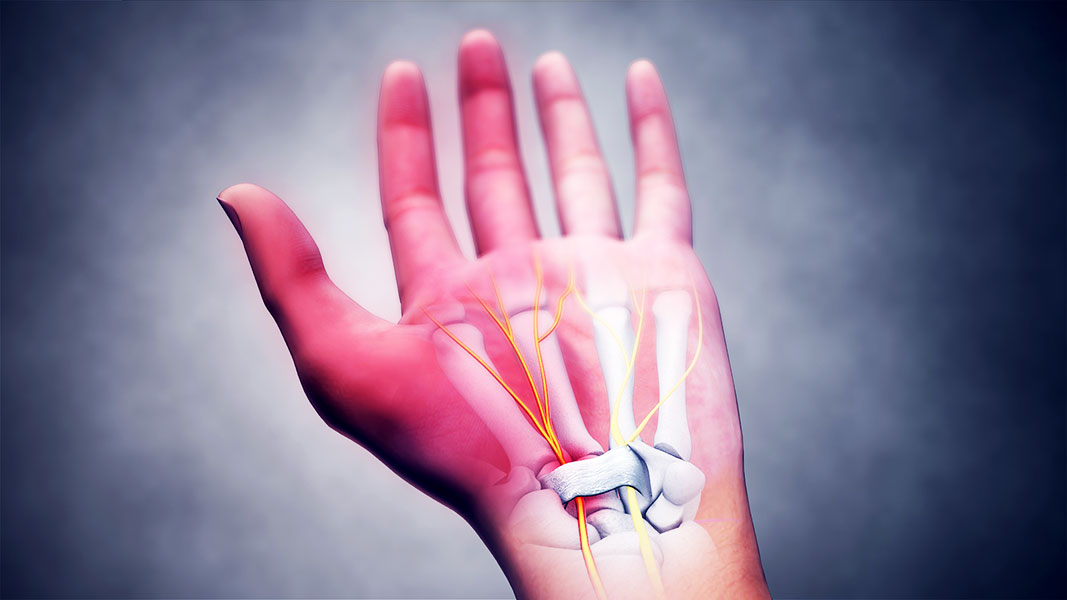Σύνδρομο Καρπιαίου Σωλήνα: Αποκατάσταση με Φυσικοθεραπεία
